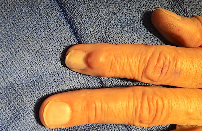 Mucous Cyst Hand Surgery Resource